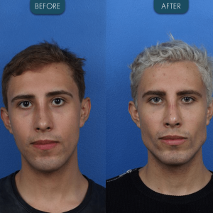 Chin implant Before and After - Zaren Health