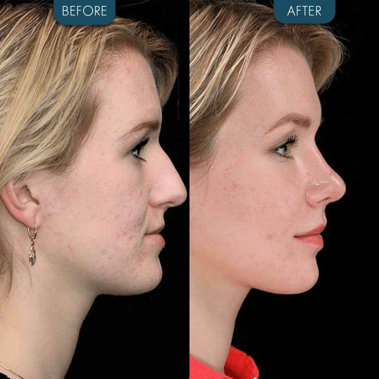 Chin implant Before and After - Zaren Health
