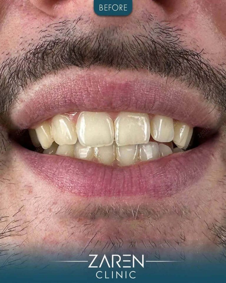 Where To Have A Tooth Done In Istanbul? Types of Dental Aesthetics in ...