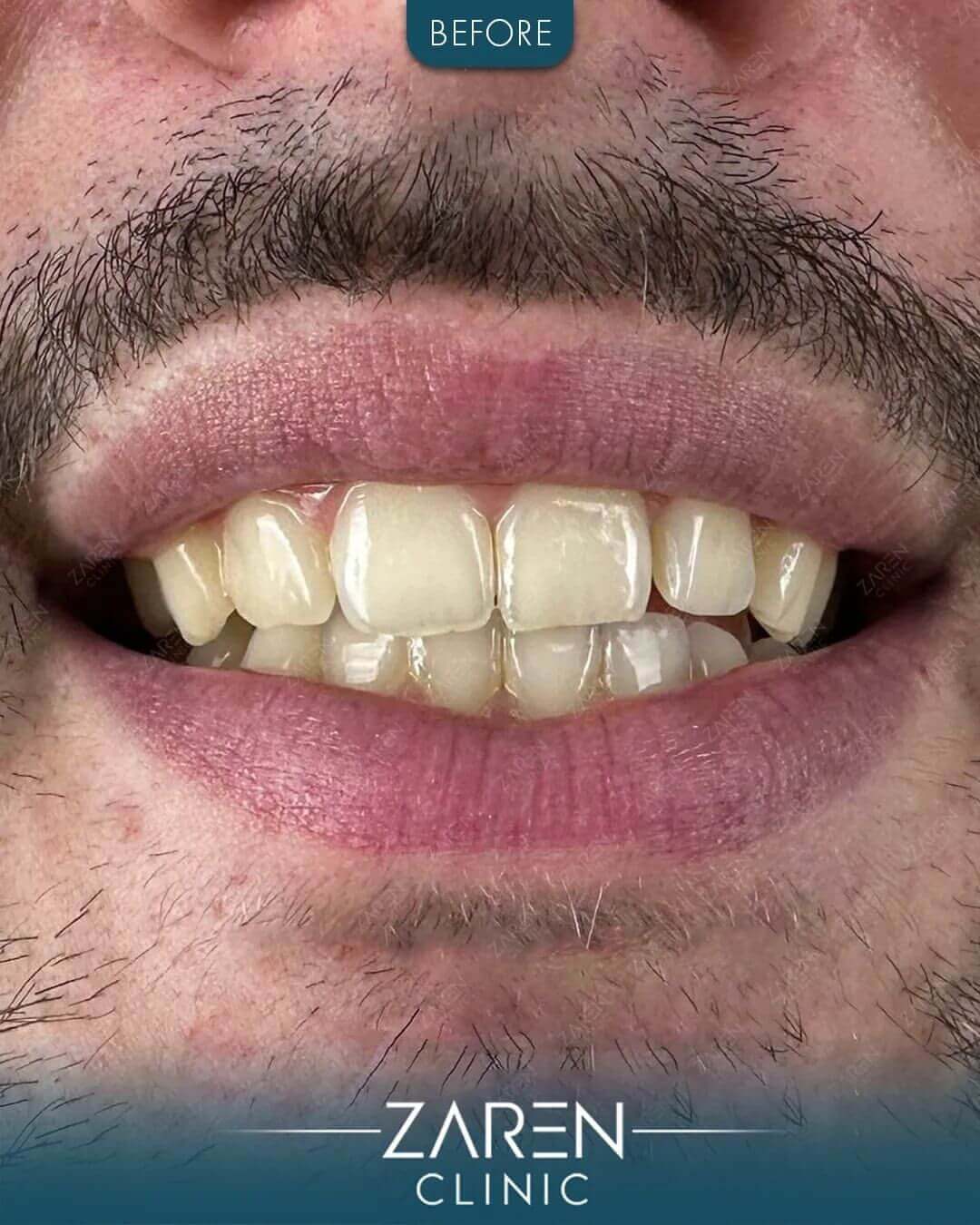 Where To Have A Tooth Done In Istanbul? Types of Dental Aesthetics in ...