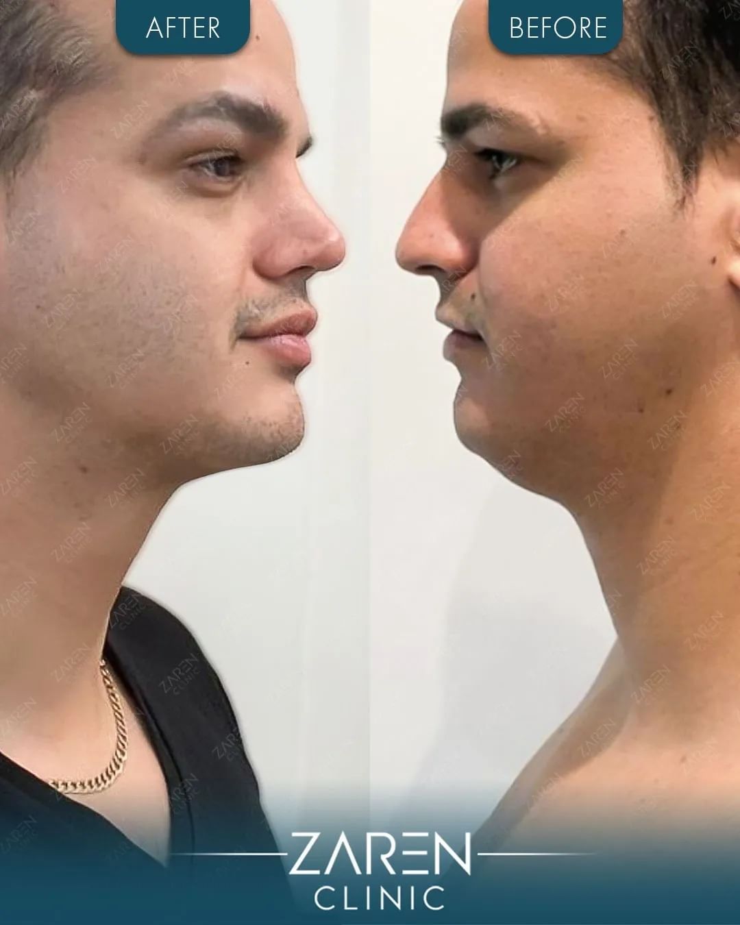 Rhinoplasty for Men: Why More Men are Choosing Turkey for Nose Surgery ...