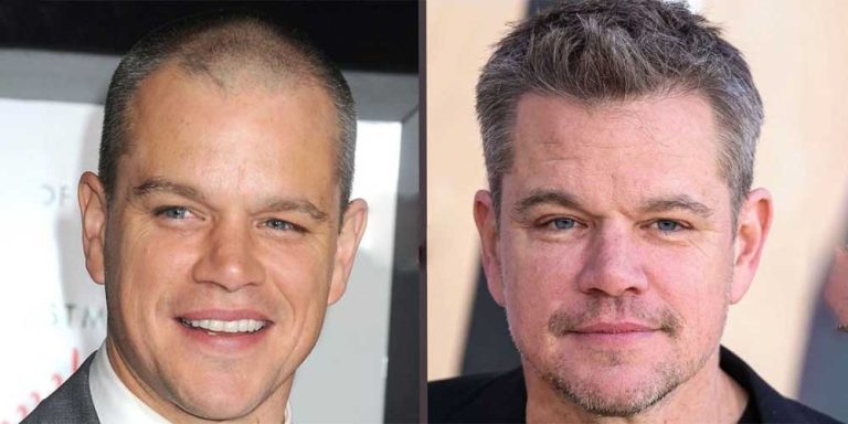 Matt Damon Hair Transplant Journey: A Transformation of Confidence - Zaren Health