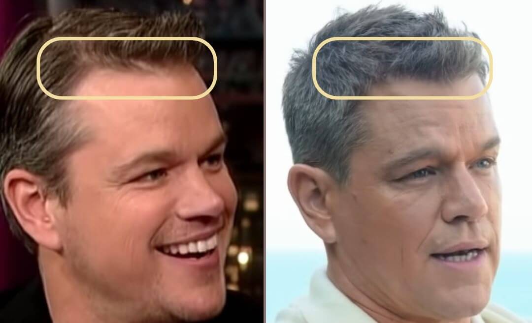 Matt Damon Hair Transplant Journey: A Transformation of Confidence - Zaren Health