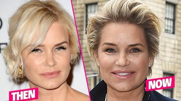 Celebrities Who Had Plastic Surgery: We Examined 41 Stars - Zaren Health