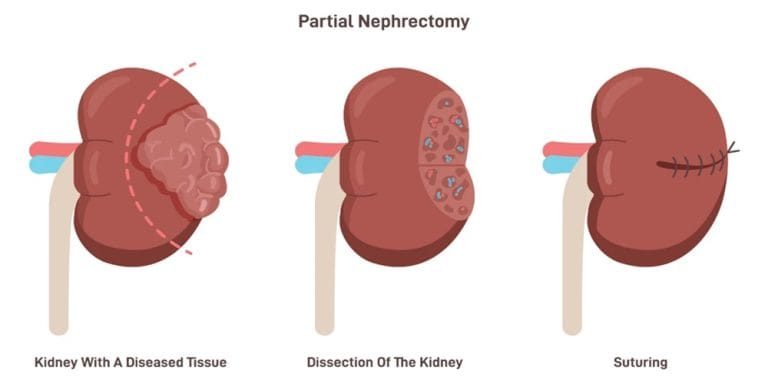 Kidney Cancer Treatment in Turkey: World-Class Care at Affordable ...