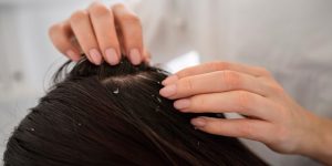 Qu'est-ce que l'eczéma du cuir chevelu ? Symptômes, causes et options ...