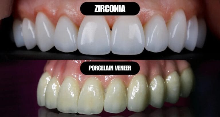 Zirconium Crowns vs. Porcelain Veneers: Which is Better for Dental ...