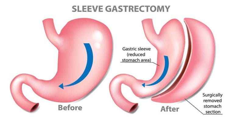 Gastric Sleeve Diet: What to Eat Before and After - Zaren Health