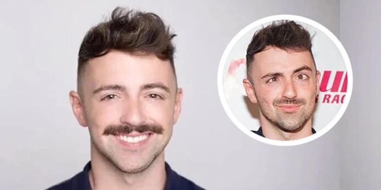 Matteo Lane Hair Transplant - Zaren Health