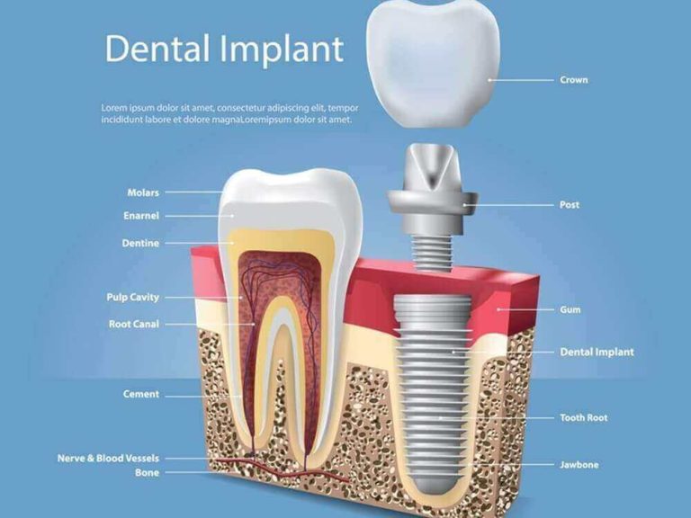What are Dental Implants? Permanent Solution for Missing Teeth - Zaren Health